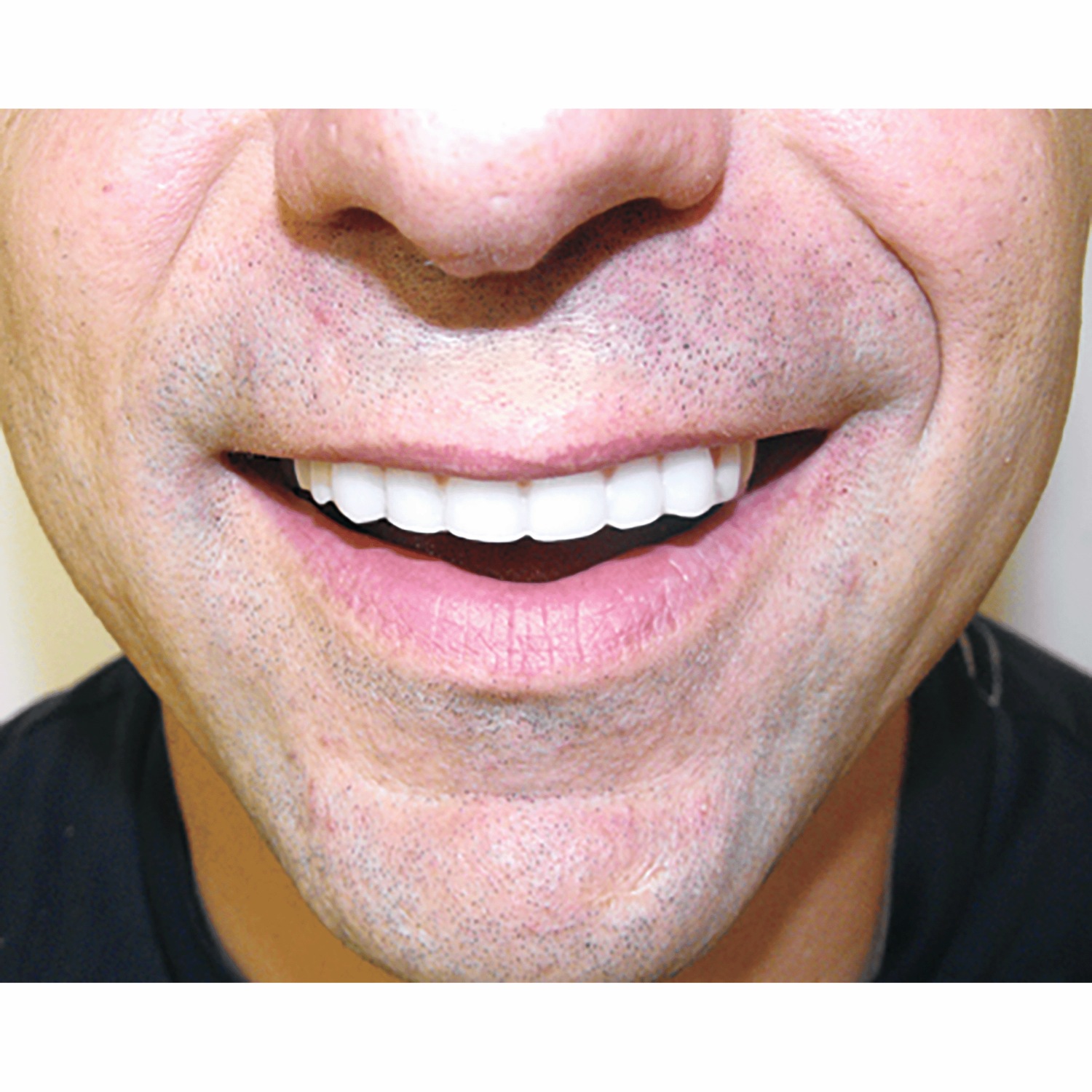 Instant Smile Veneer | Amerimark