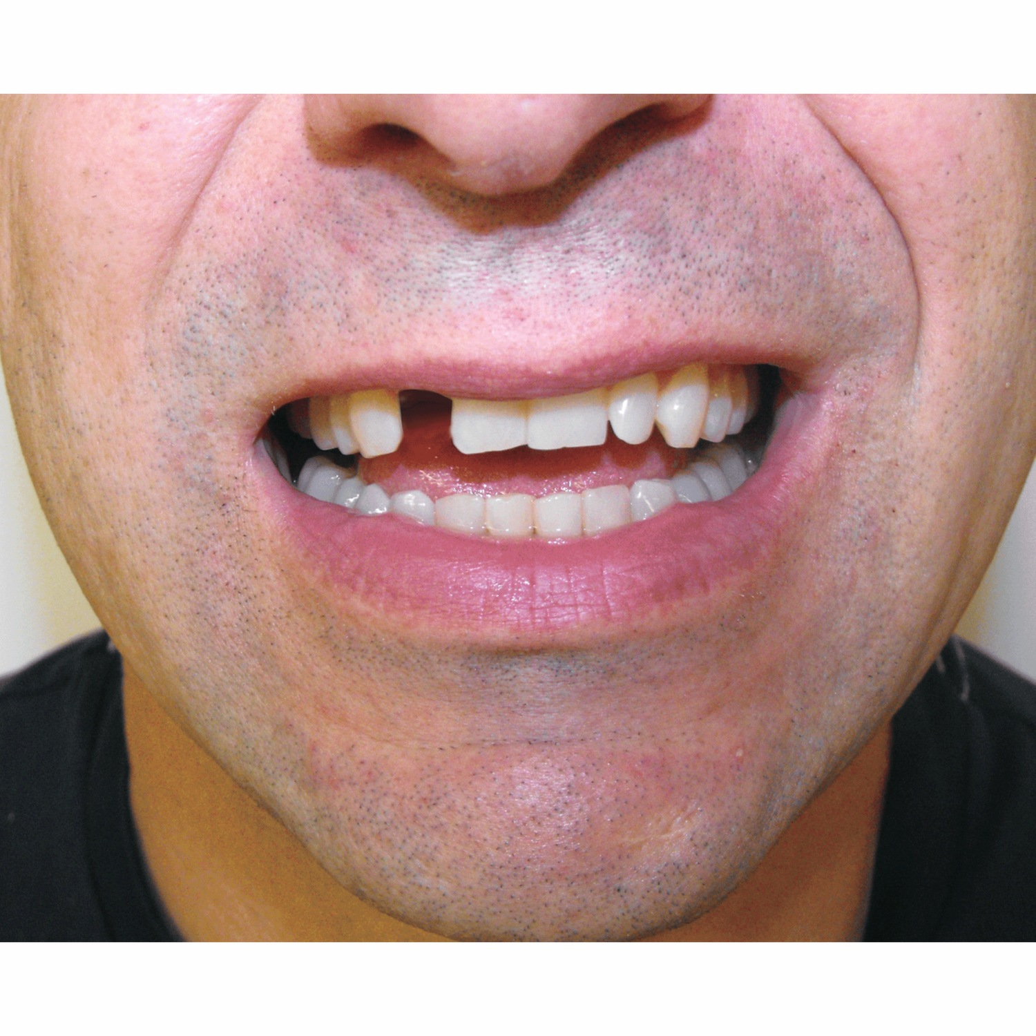 Instant Smile Veneer | Amerimark